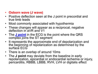OSBORN WAVE (J Wave) IN ECG AND ITS INTERPRETATION | PPT