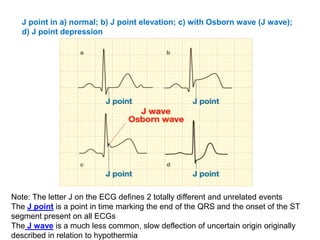 OSBORN WAVE (J Wave) IN ECG AND ITS INTERPRETATION | PPT