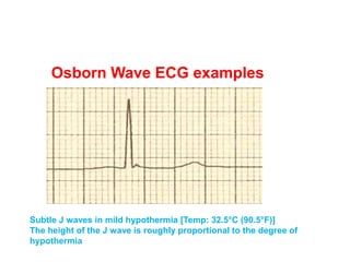 OSBORN WAVE (J Wave) IN ECG AND ITS INTERPRETATION | PPT