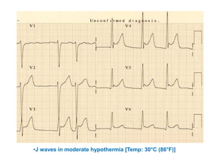 OSBORN WAVE (J Wave) IN ECG AND ITS INTERPRETATION | PPT