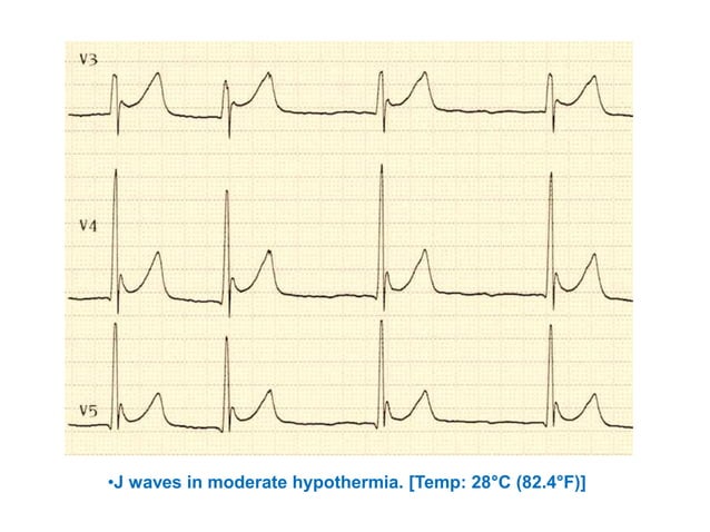 OSBORN WAVE (J Wave) IN ECG AND ITS INTERPRETATION | PPT