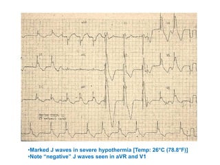 OSBORN WAVE (J Wave) IN ECG AND ITS INTERPRETATION | PPT