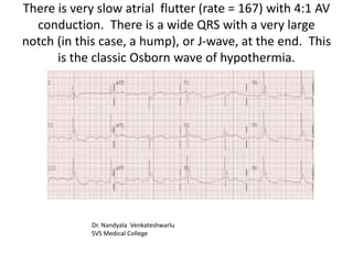 Osborn wave venkat ppt | PPTX