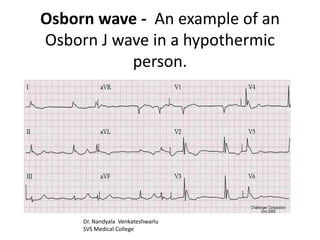 Osborn wave venkat ppt | PPT