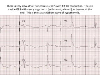 Osborn wave venkat ppt | PPT