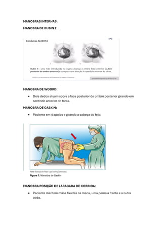 Manobra das distorcias no trabalho de parto | PDF
