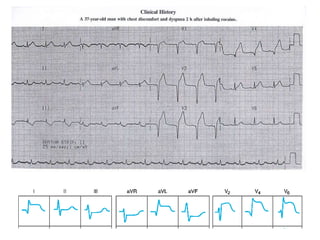 Osce ecg | PPT