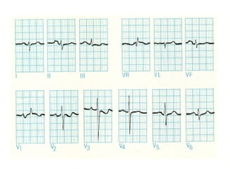 Osce ecg | PPT
