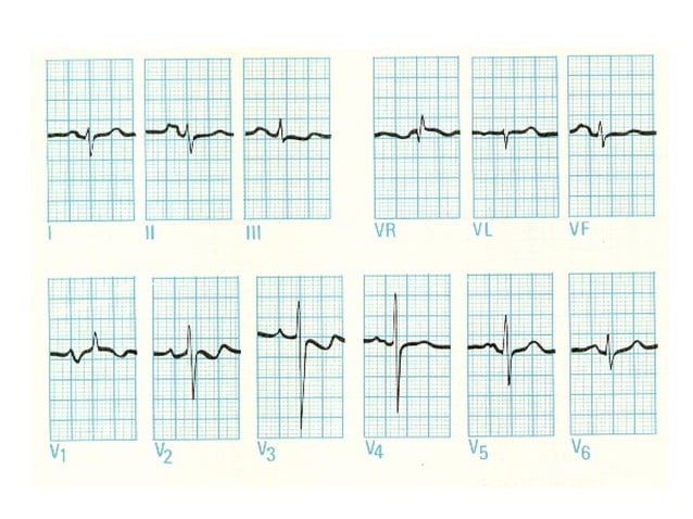Osce ecg | PPT | Heart and Cardiovascular Diseases | Diseases and ...