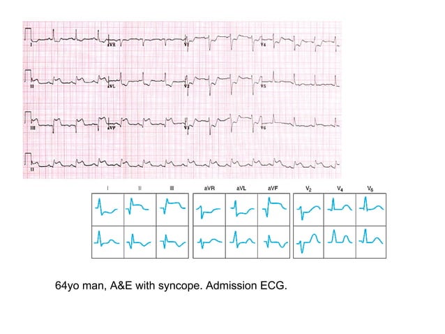 Osce ecg | PPT | Heart and Cardiovascular Diseases | Diseases and ...