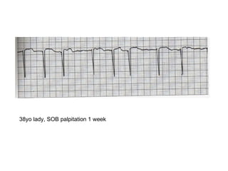 Osce ecg | PPT