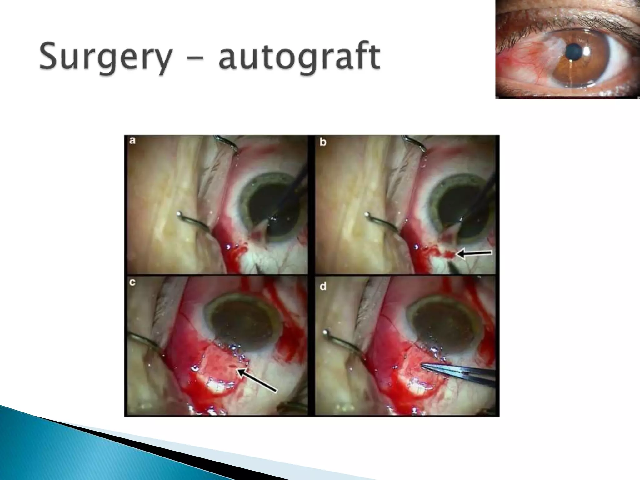 Pterygium Surgery | PPTX