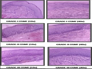 Oral Submucous Fibrosis (OSF) | PPT