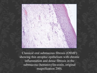 Oral Submucous Fibrosis (OSF) | PPT