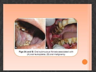 Oral Submucous Fibrosis (OSF) | PPT