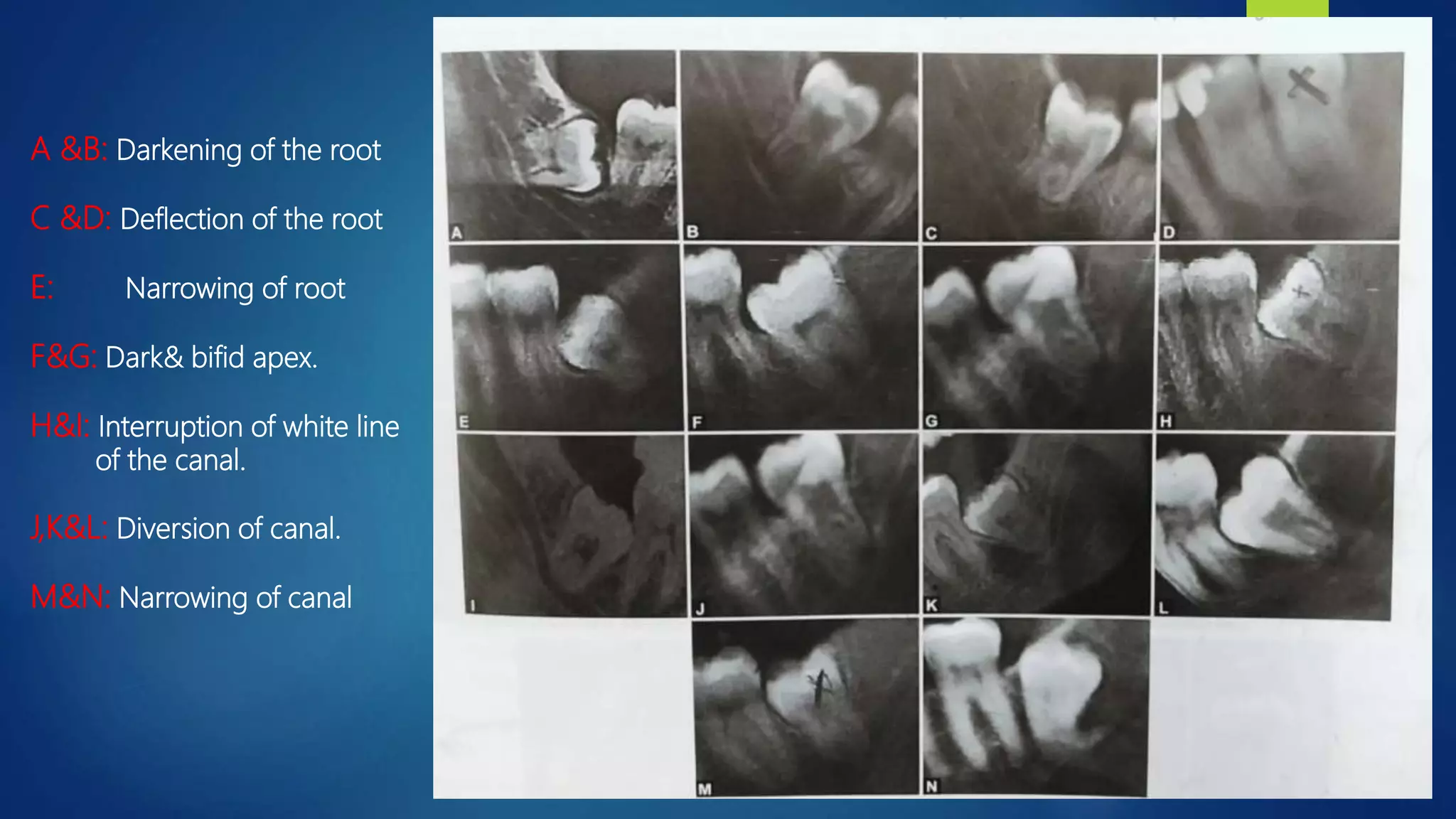 Mandibular 3rd molar impacion | PPTX
