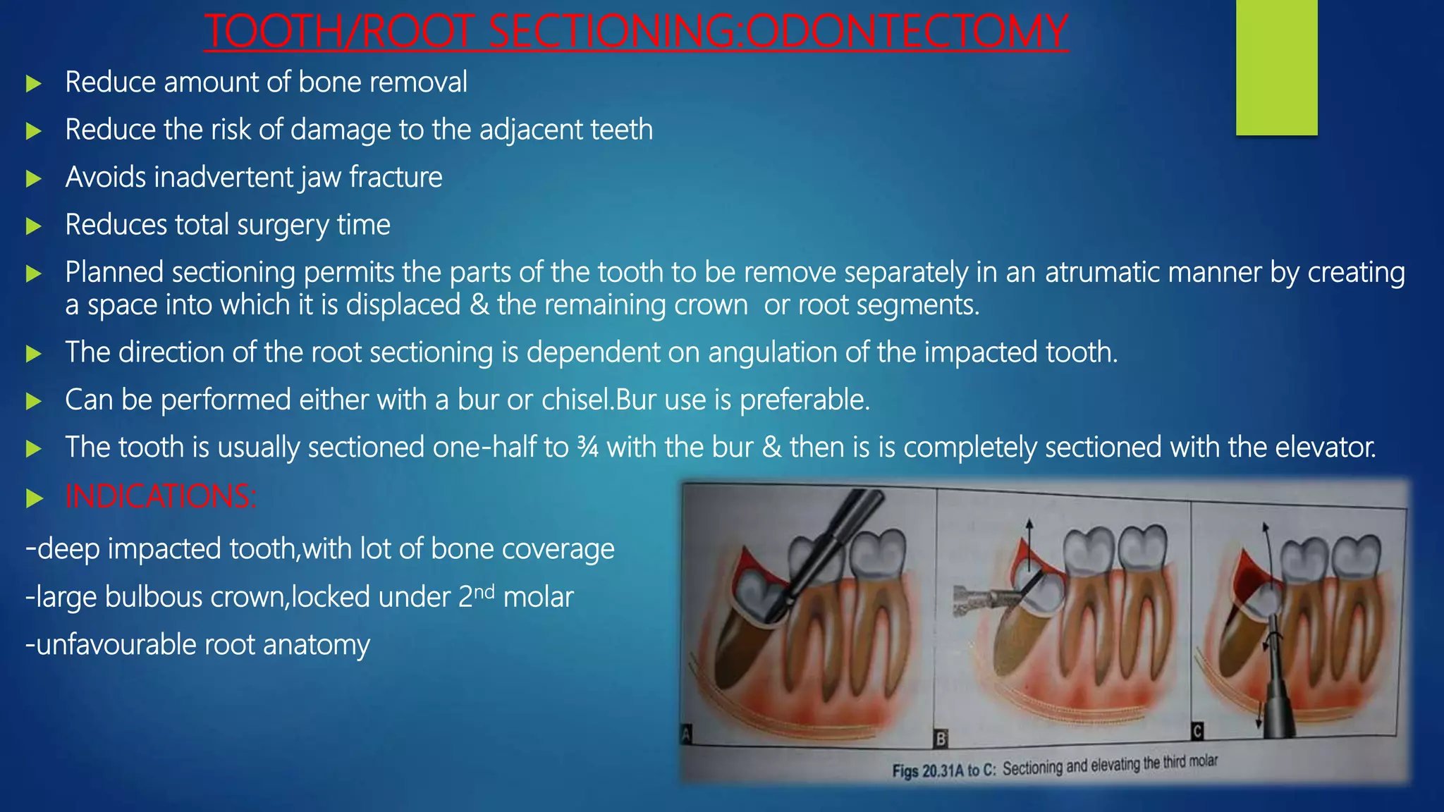 Mandibular 3rd molar impacion | PPTX