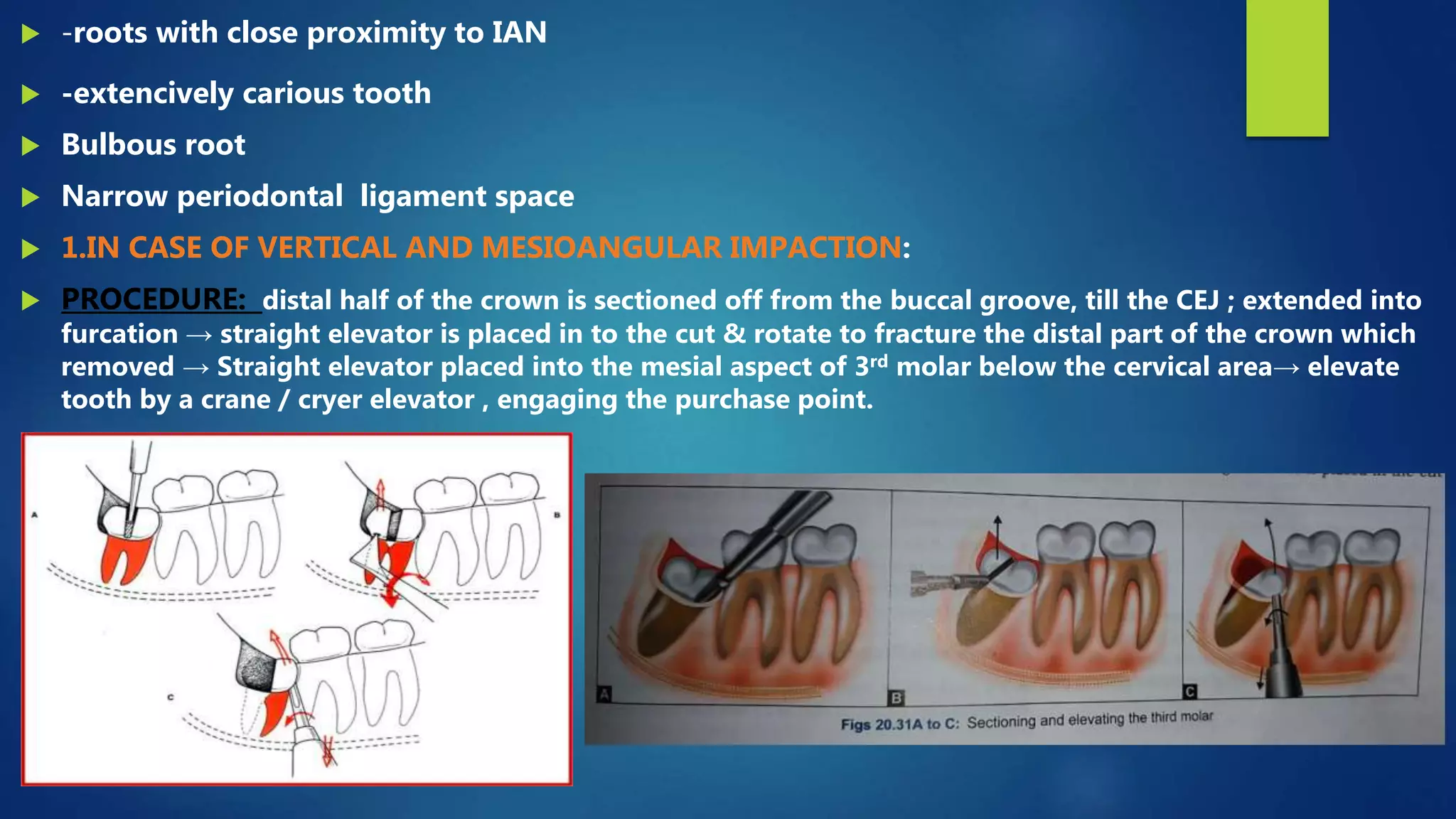 Mandibular 3rd molar impacion | PPTX