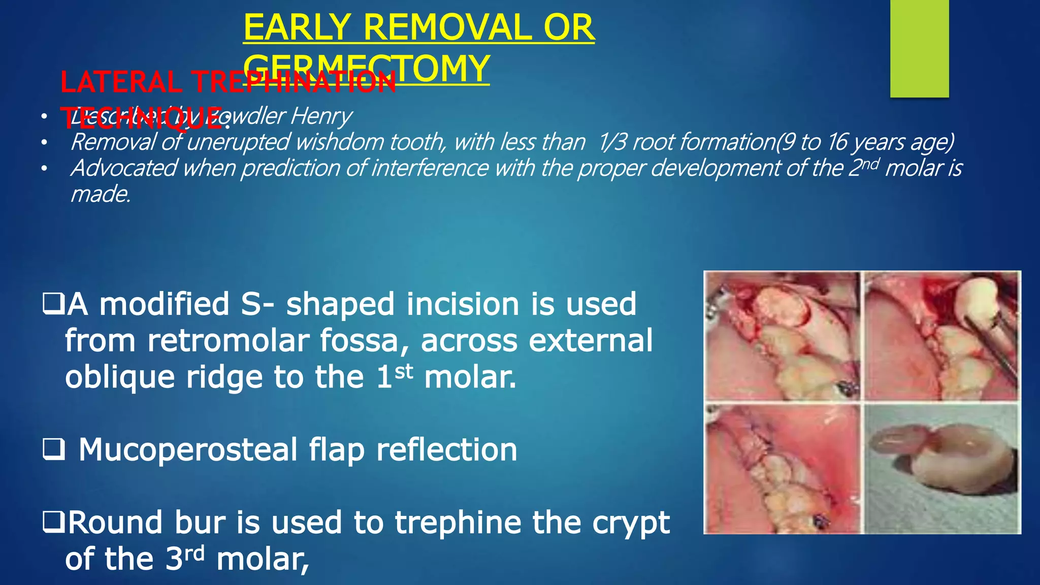 Mandibular 3rd molar impacion | PPTX