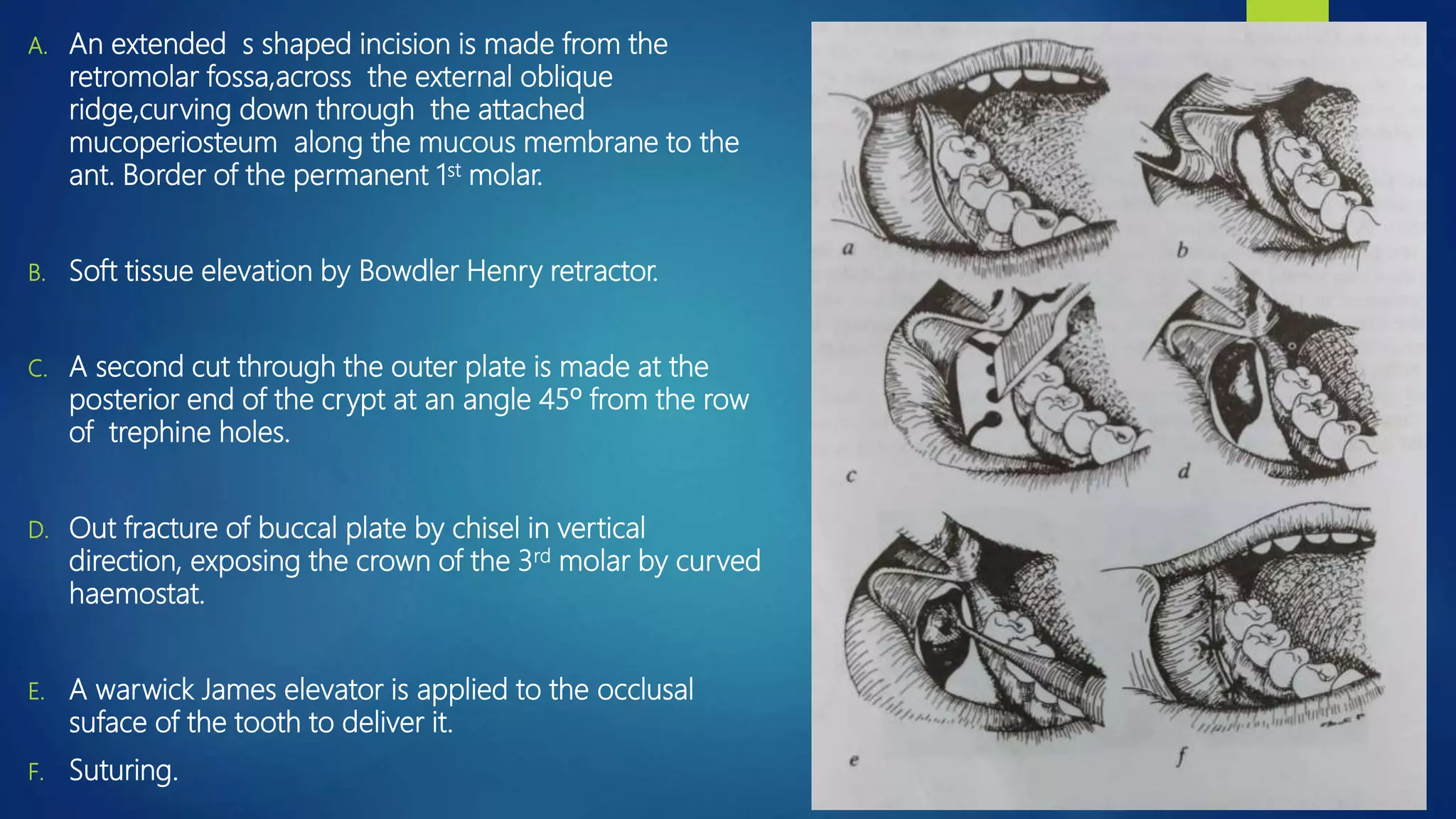 Mandibular 3rd molar impacion | PPTX