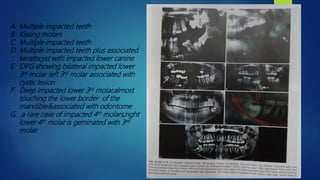 Mandibular 3rd molar impacion | PPT