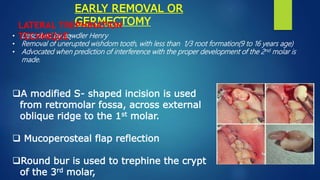 Mandibular 3rd molar impacion | PPTX