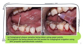 ONE STAGE FULL MOUTH DISINFECTION | PPTX