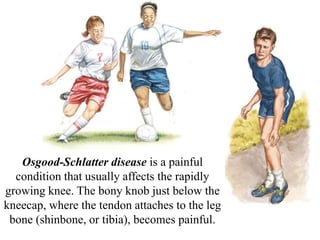 Osgood-Schlatter Disease | PPTX