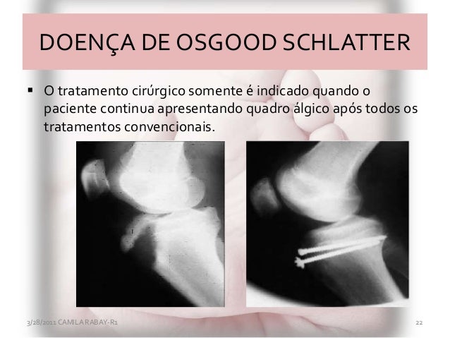 Doença de Osgood Schlatter