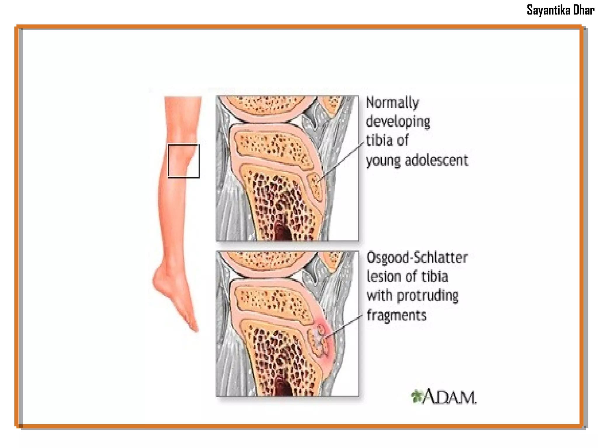 Osgood Schlatter Disease Ppt