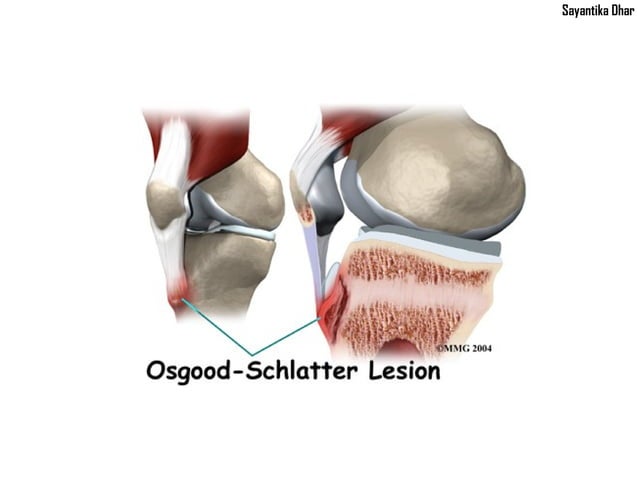 Osgood Schlatter Disease | PPT