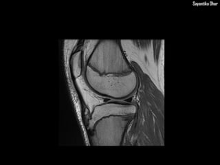 Osgood Schlatter Disease Mri