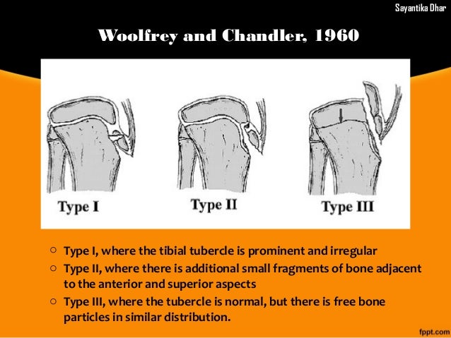 Osgood Schlatter Disease