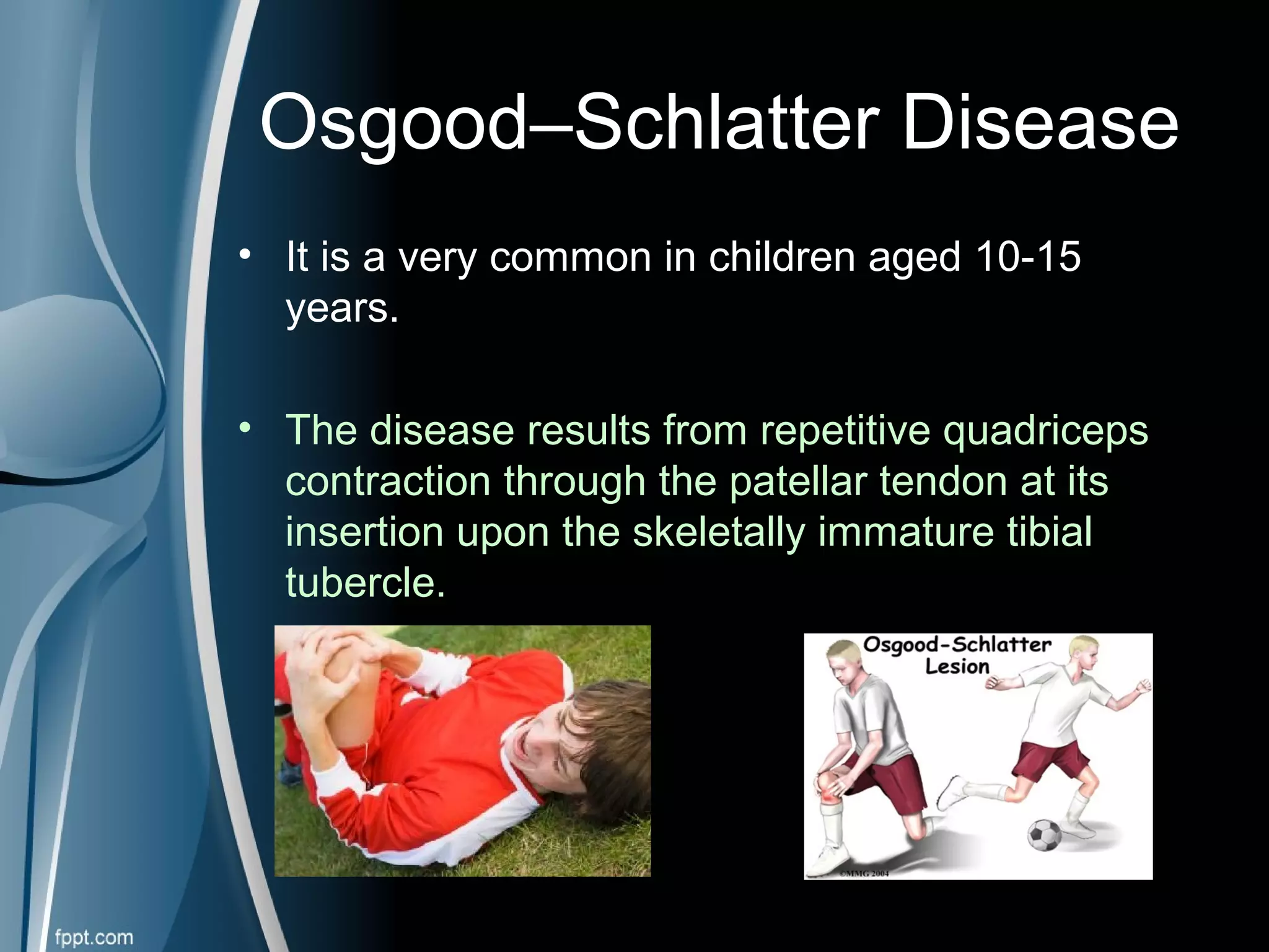 Osgood–Schlatter Disease | PPT