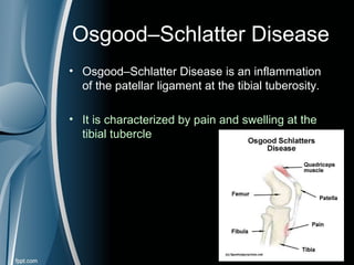Osgood–Schlatter Disease | PPT