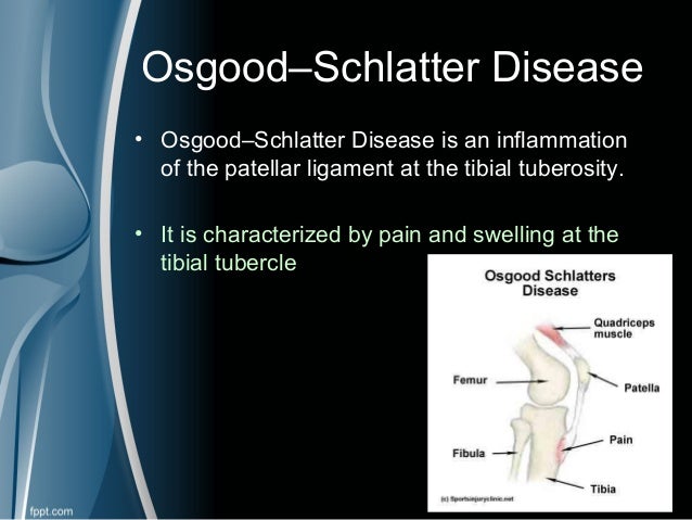 Osgood Schlatter Disease
