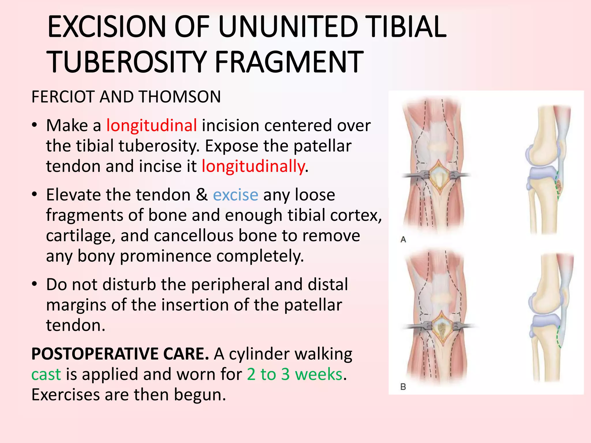 Osgood schlatter disease | PPTX