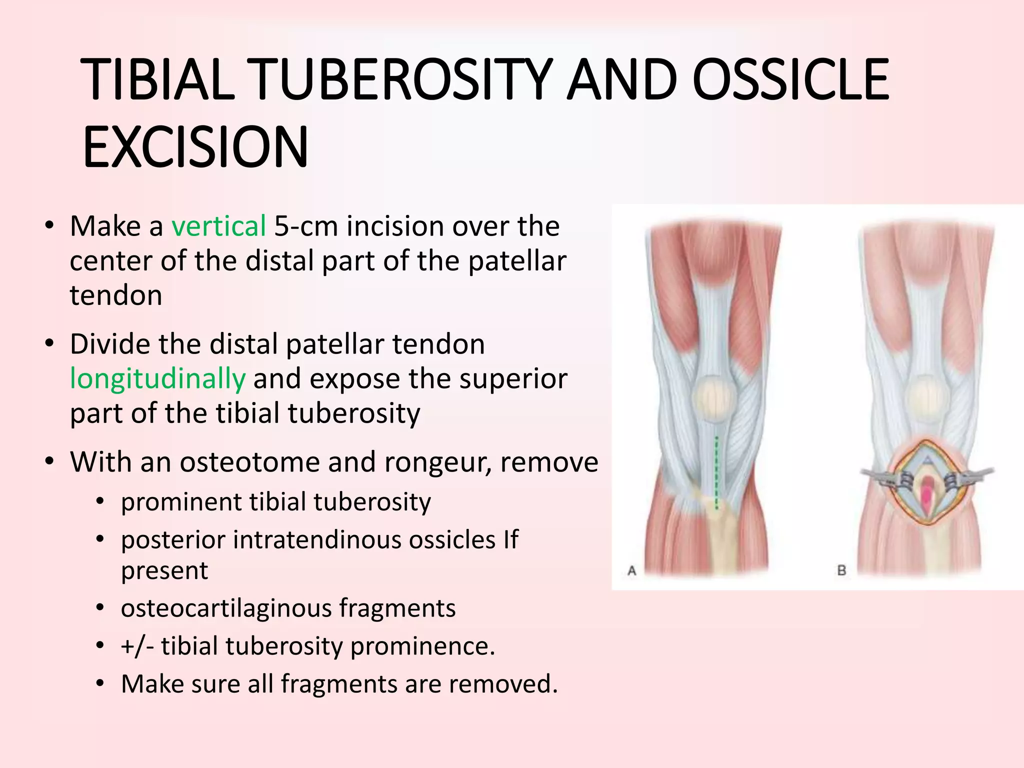 Osgood schlatter disease | PPTX