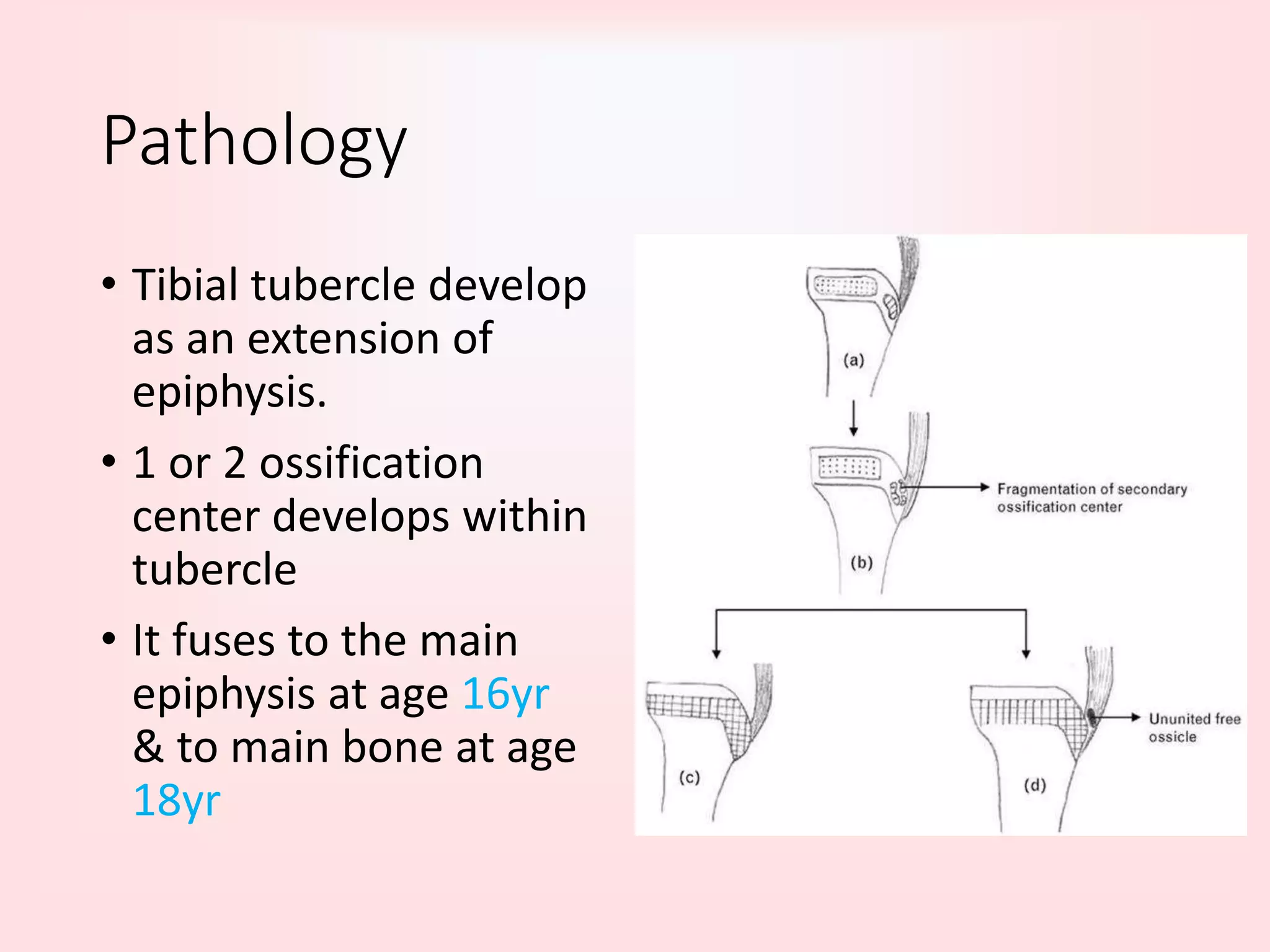 Osgood schlatter disease | PPTX