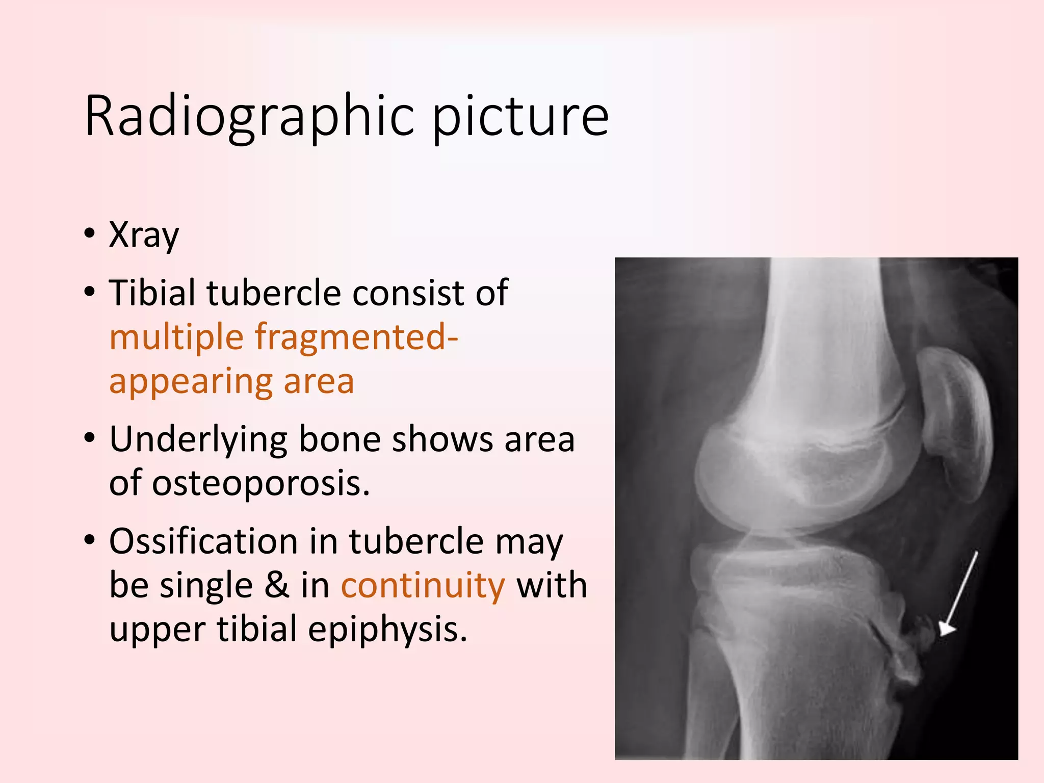 Osgood Schlatter Disease Ppt Free Download