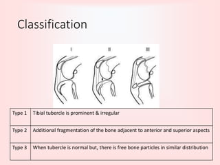 Osgood schlatter disease | PPTX