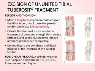Osgood schlatter disease | PPTX