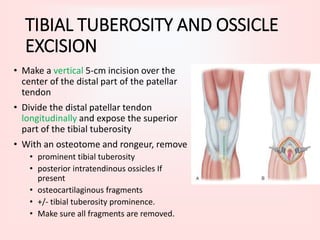 Osgood schlatter disease | PPTX