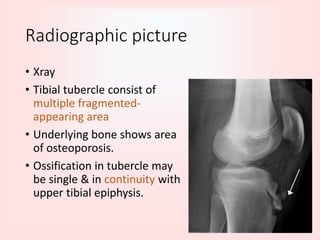 Osgood schlatter disease | PPTX