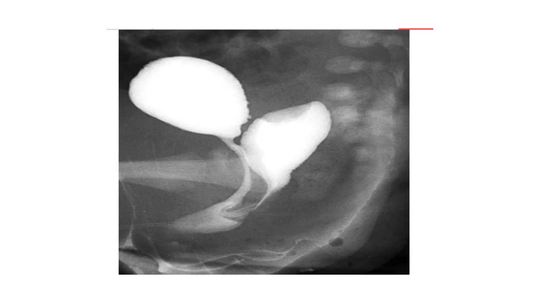 oshiba feminizing genitoplasty.pptx