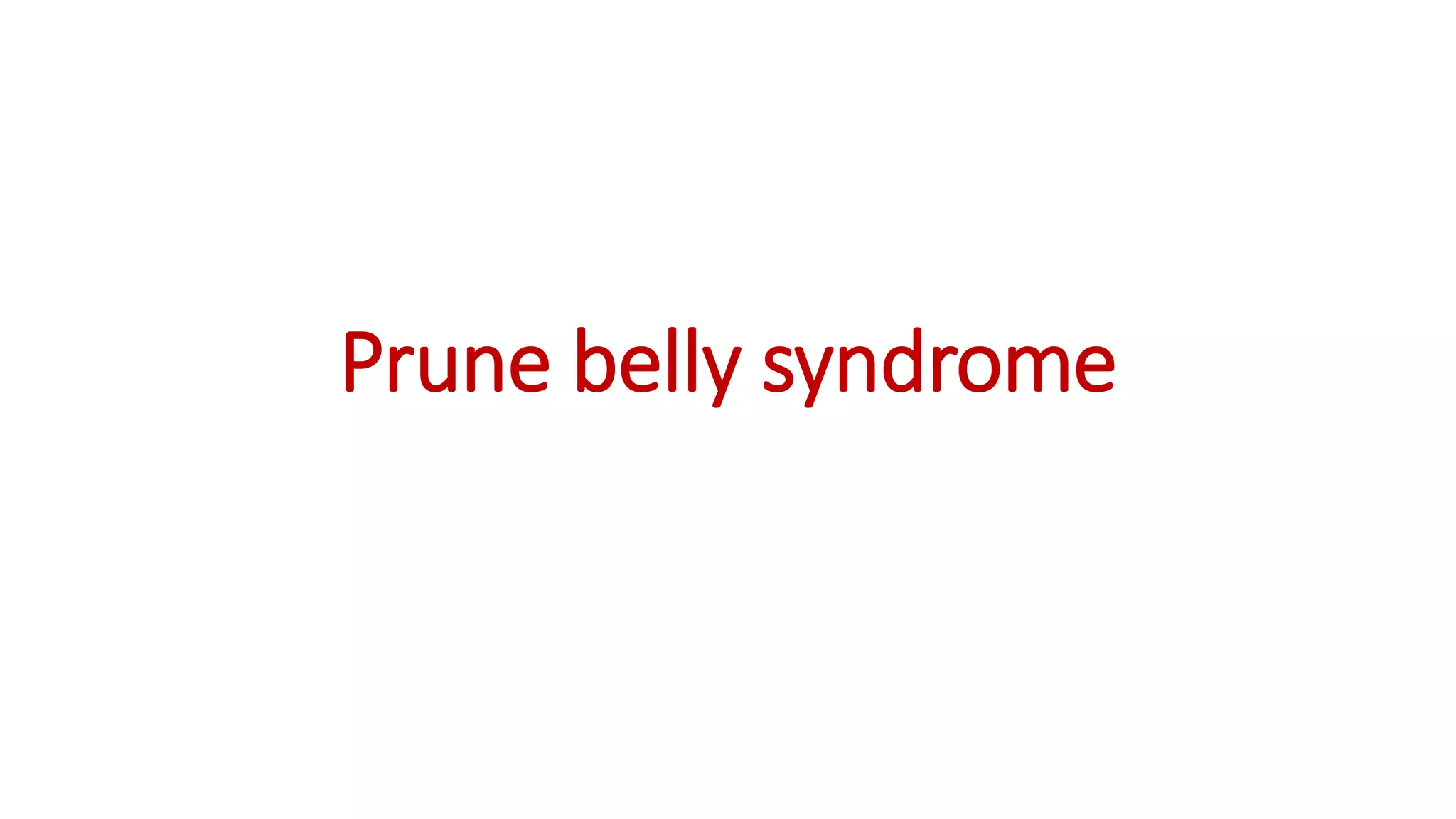 oshiba prune belly syndrome.pptx
