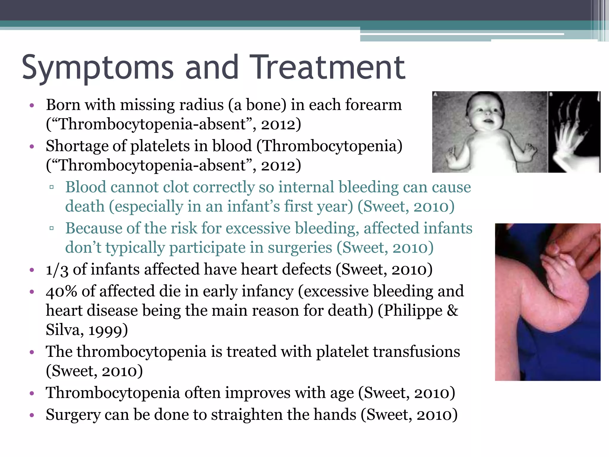 Thrombocytopenia Absent Radius Syndrome | PPT