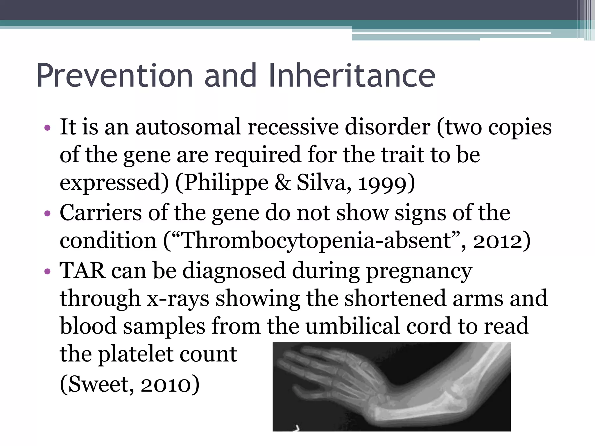 Thrombocytopenia Absent Radius Syndrome | PPT