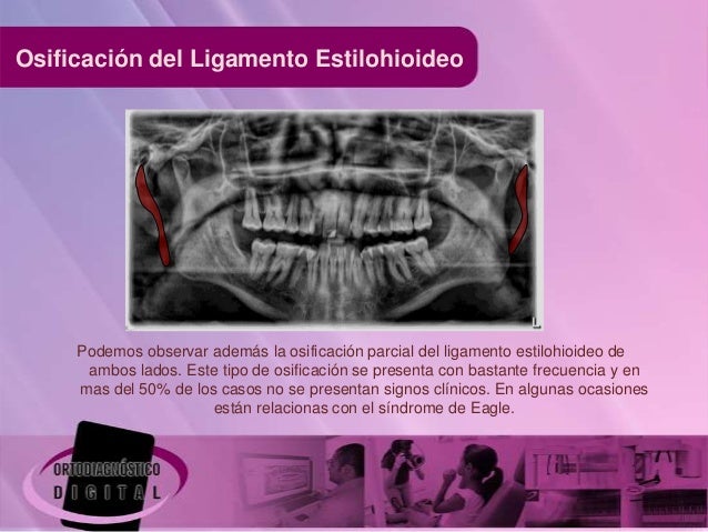 Osificacion del ligamento estilohioideo