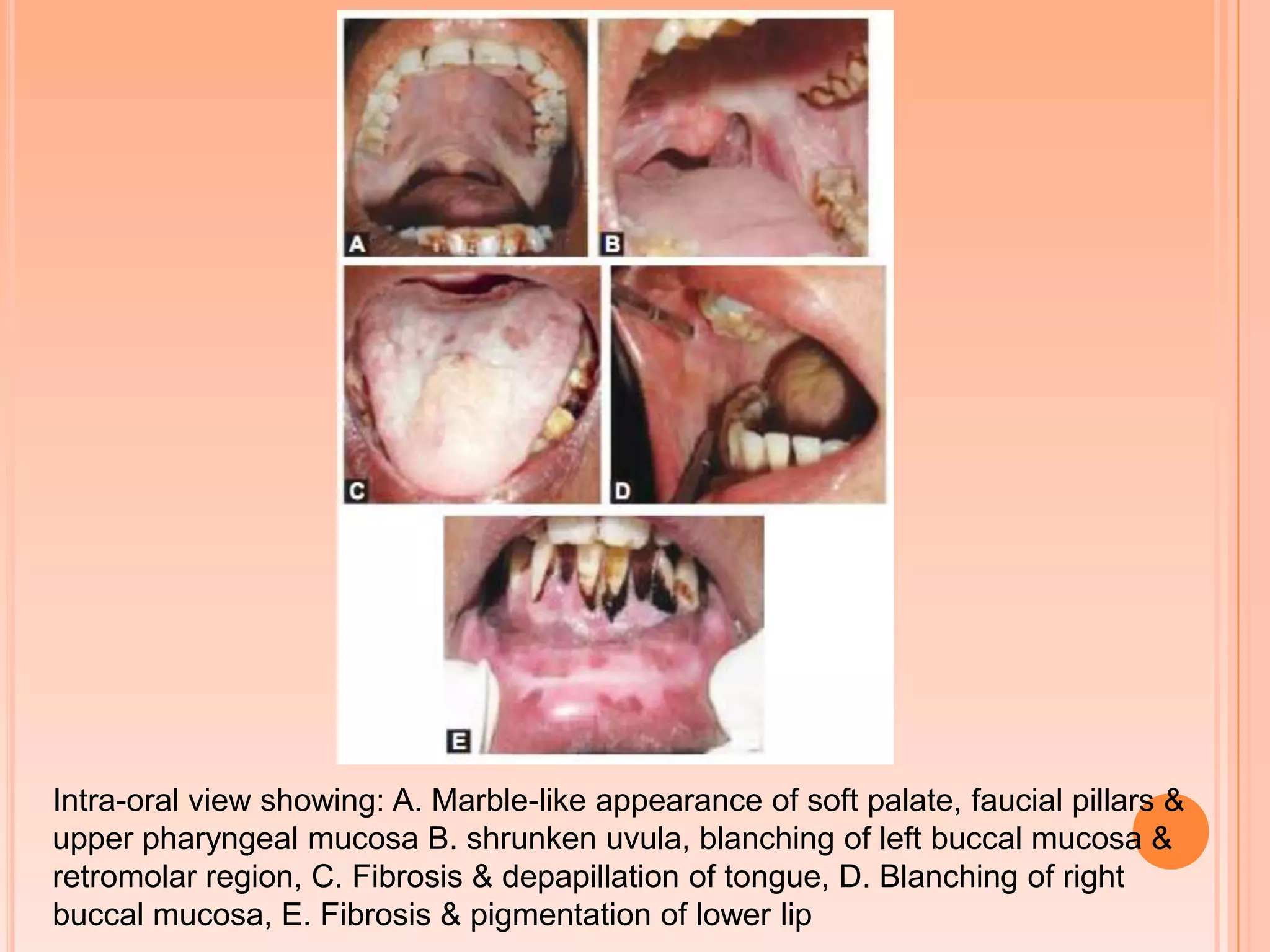 Oral Submucous Fibrosis | PPTX